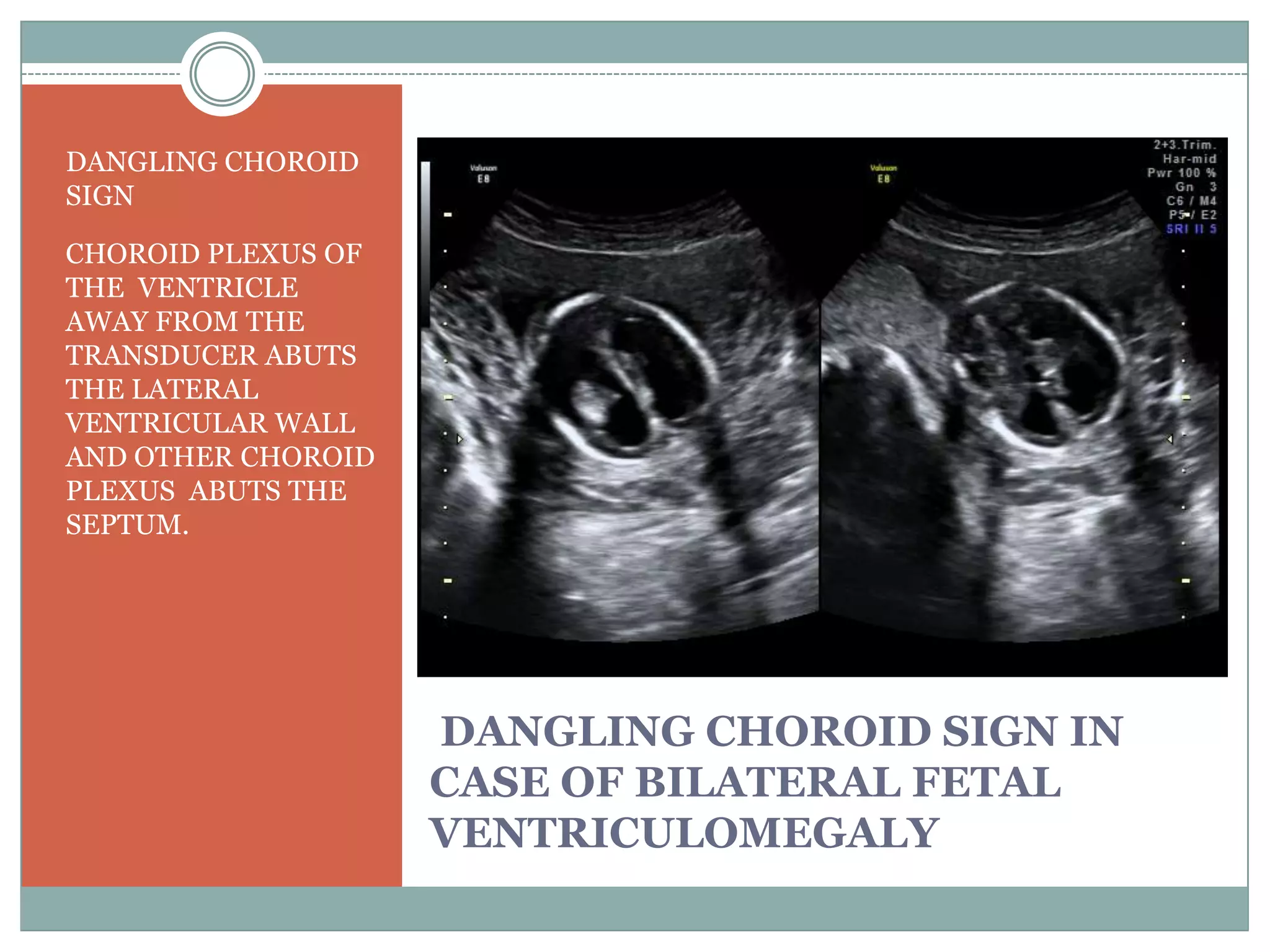 Congenital lateral ventriculomegaly. | PPTX