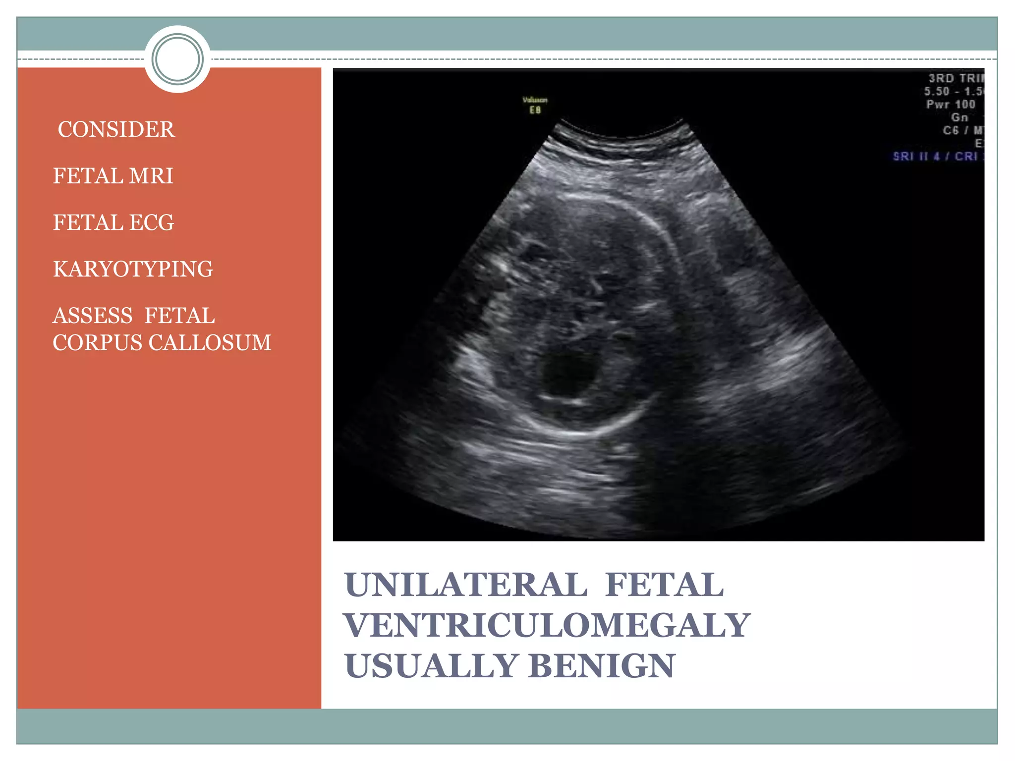 Congenital lateral ventriculomegaly. | PPTX