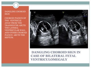 Congenital lateral ventriculomegaly. | PPTX