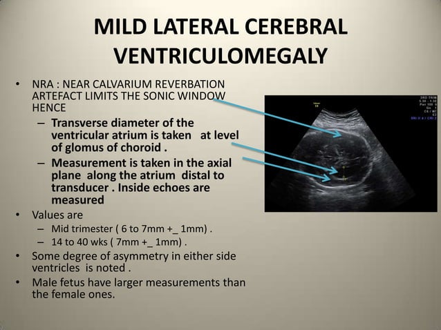 Congenital lateral ventriculomegaly. | PPTX