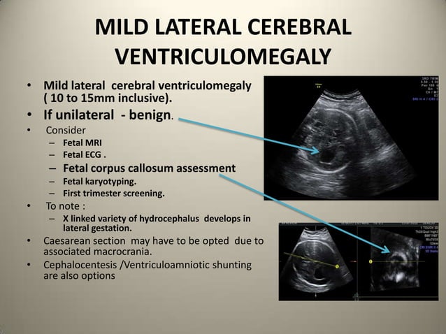 Congenital lateral ventriculomegaly. | PPTX