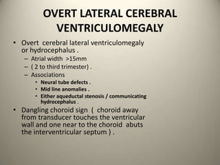 Congenital lateral ventriculomegaly. | PPTX