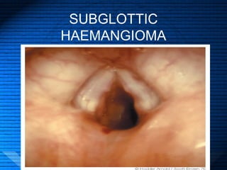 Congenital lesions of larynx | PPT