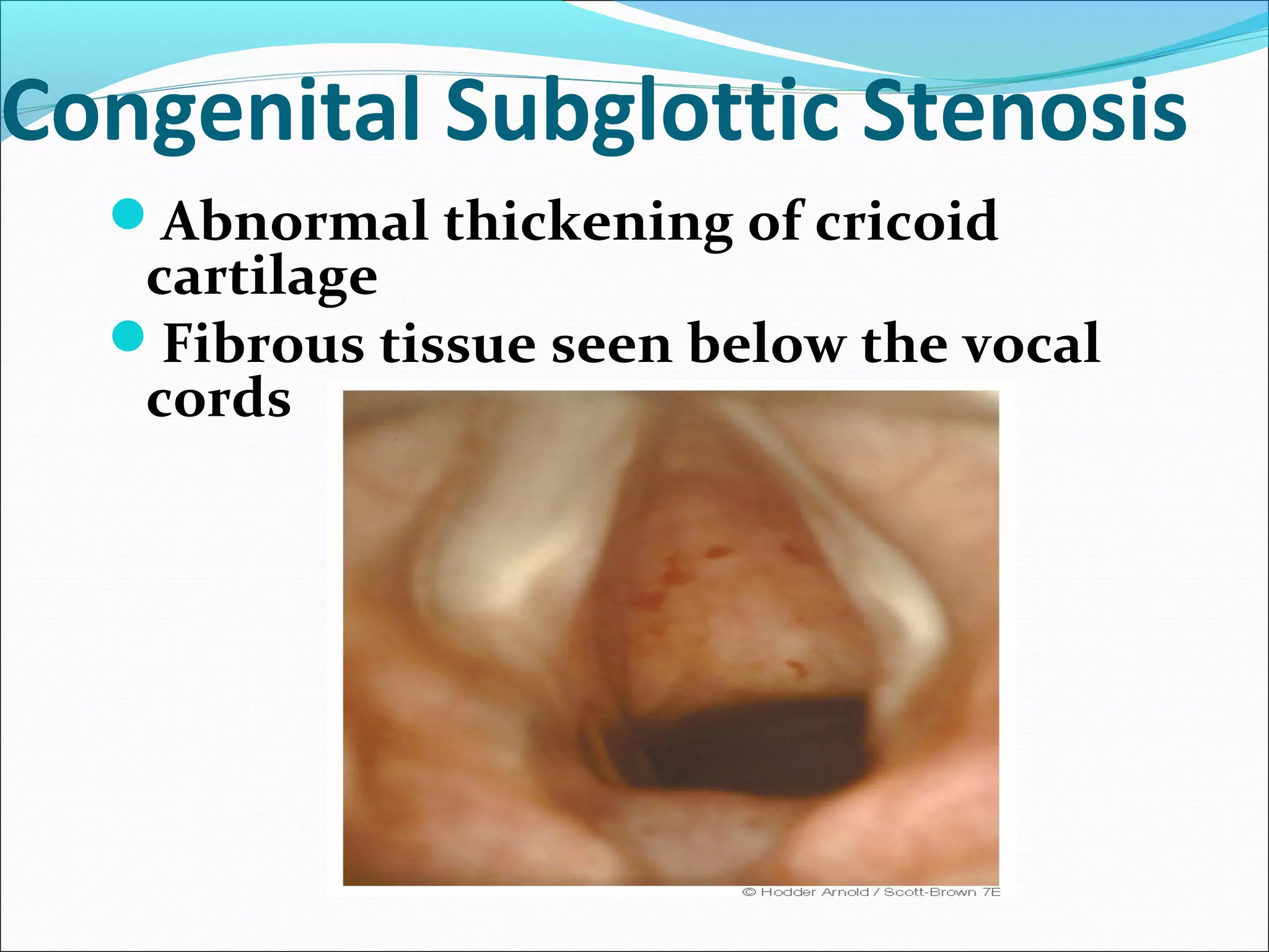 Congenital lesions of larynx and Stridor in Neonates | PPT