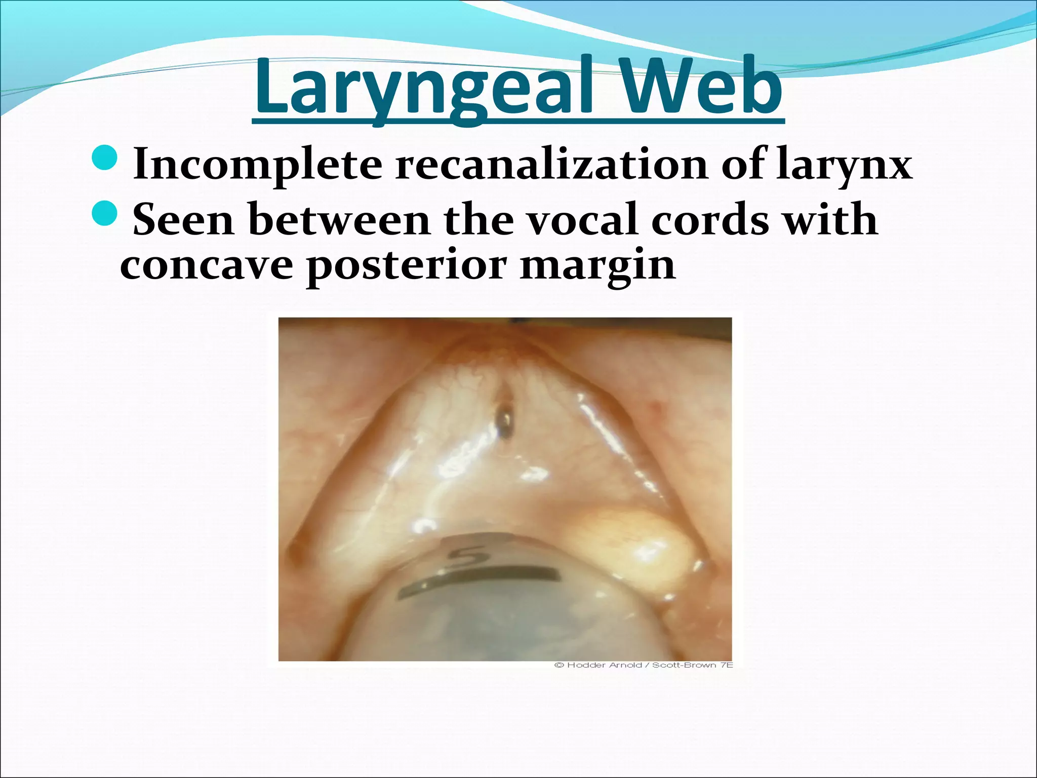 Congenital lesions of larynx and Stridor in Neonates | PPT