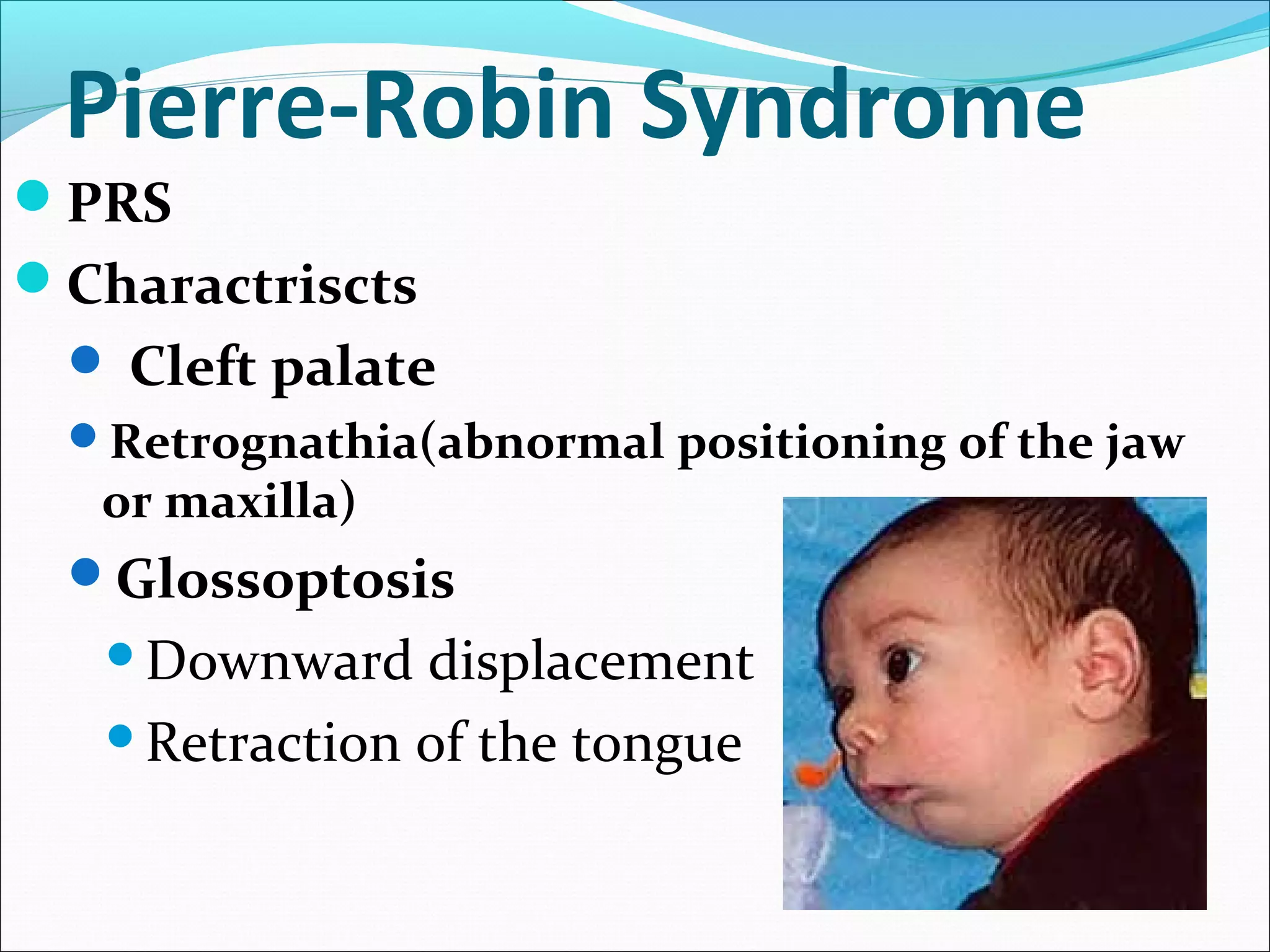 Congenital lesions of larynx and Stridor in Neonates | PPT