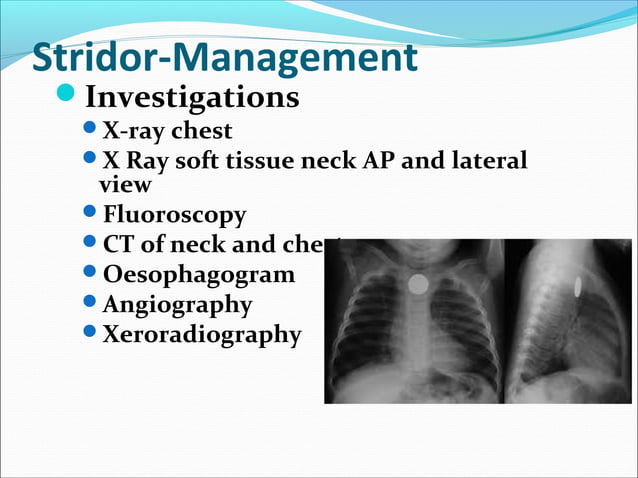 Congenital lesions of larynx and Stridor in Neonates | PPT