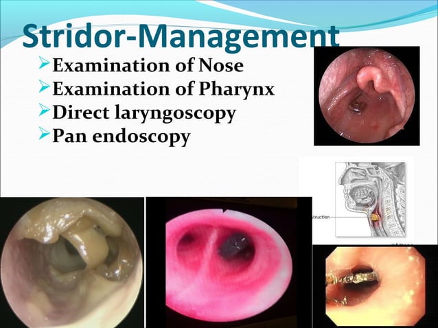 Congenital lesions of larynx and Stridor in Neonates | PPT