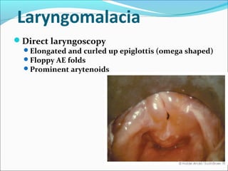 Congenital lesions of larynx and Stridor in Neonates | PPT
