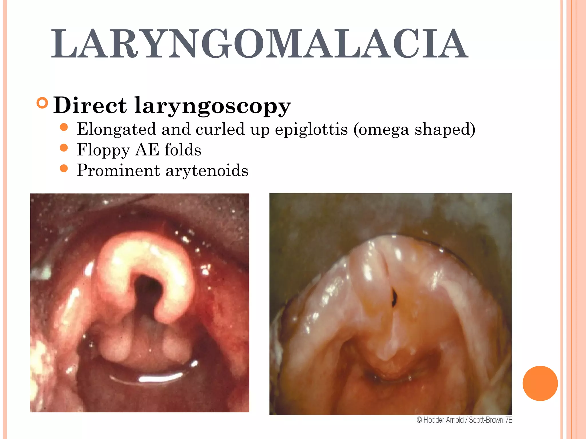 Congenital lesions of larynx and stridor management | PPT