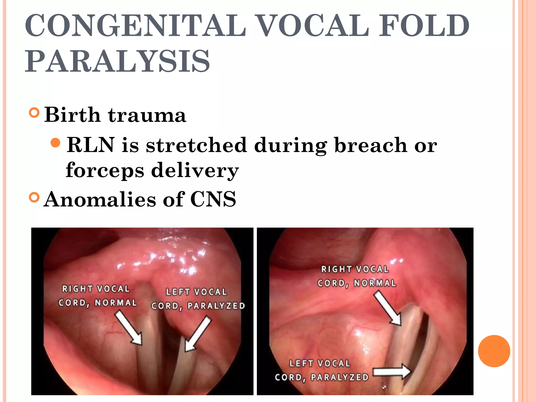 Congenital lesions of larynx and stridor management | PPT