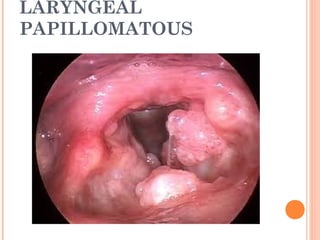 Congenital lesions of larynx and stridor management | PPT