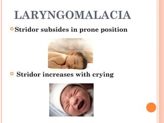Congenital lesions of larynx and stridor management | PPT