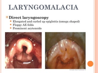 Congenital lesions of larynx and stridor management | PPT