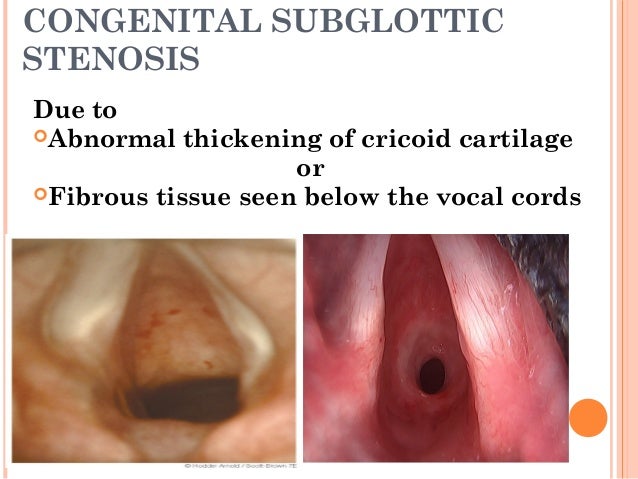 Congenital lesions of larynx and stridor management