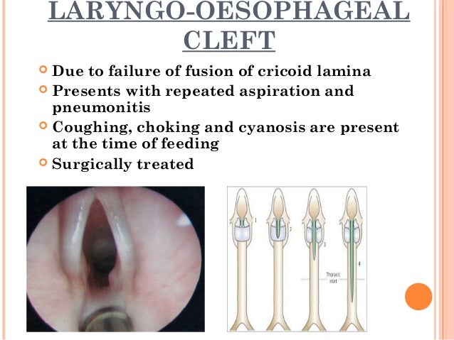 Congenital lesions of larynx and stridor management