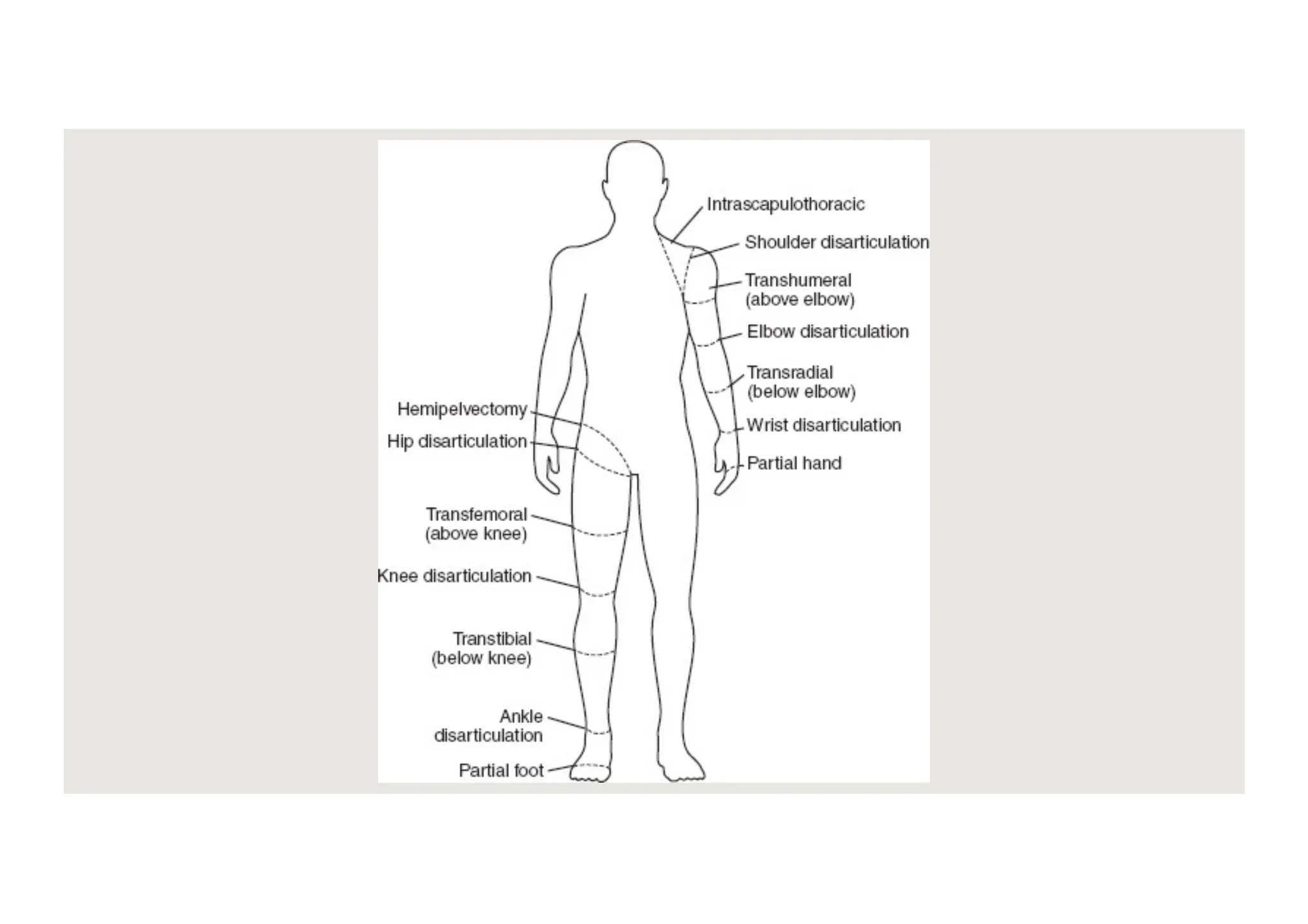 Congenital Limb deficiencies. Physiotherapy for pediatrics.pdf | Death ...