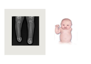 Congenital Limb deficiencies. Physiotherapy for pediatrics.pdf