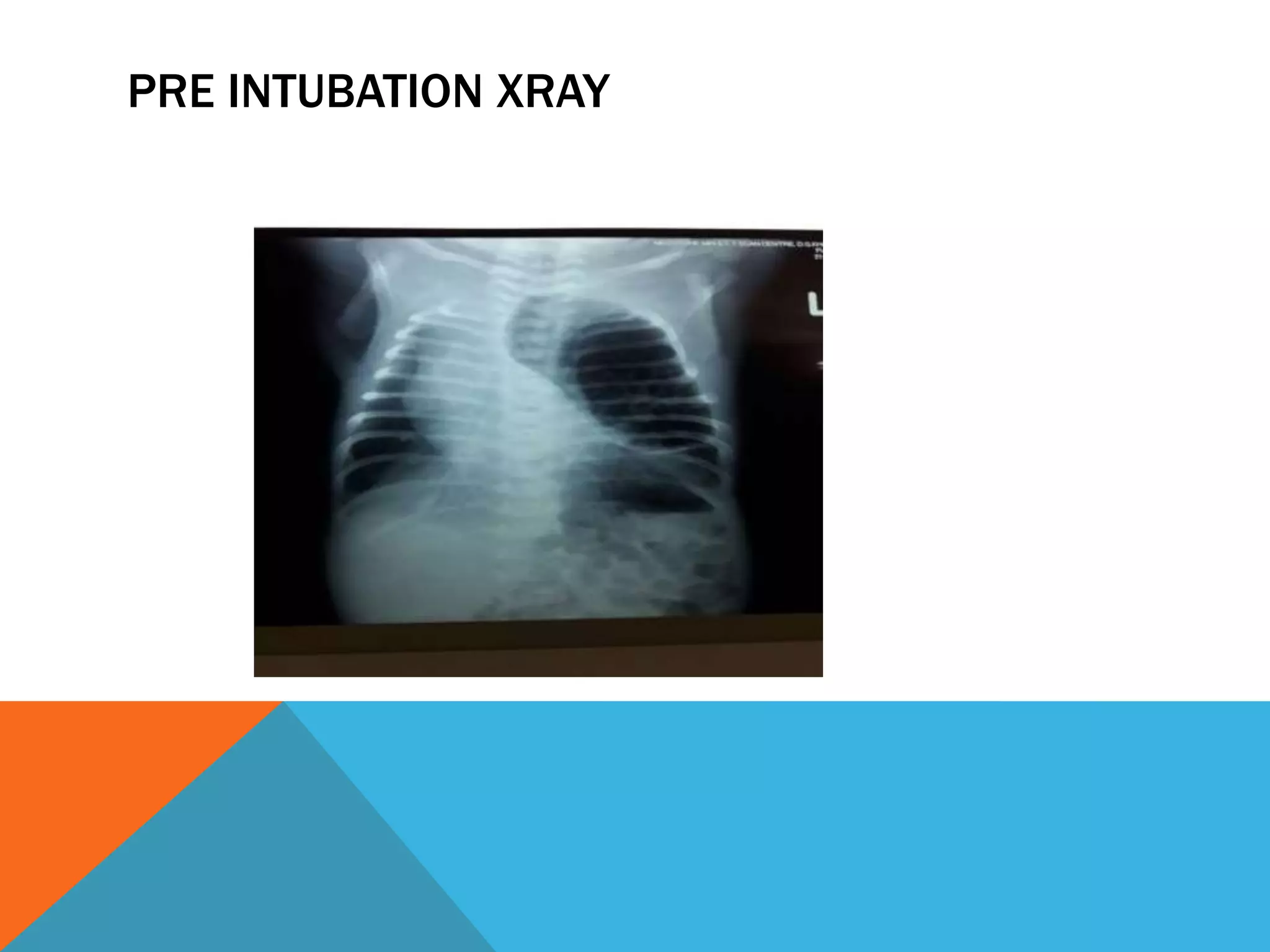Congenital lobar emphysema | PPT