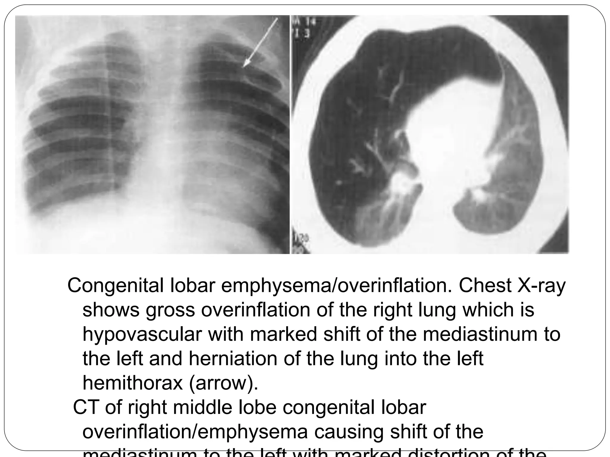 Congenital lung diseases | PPTX