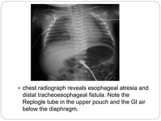 Congenital lung diseases | PPTX