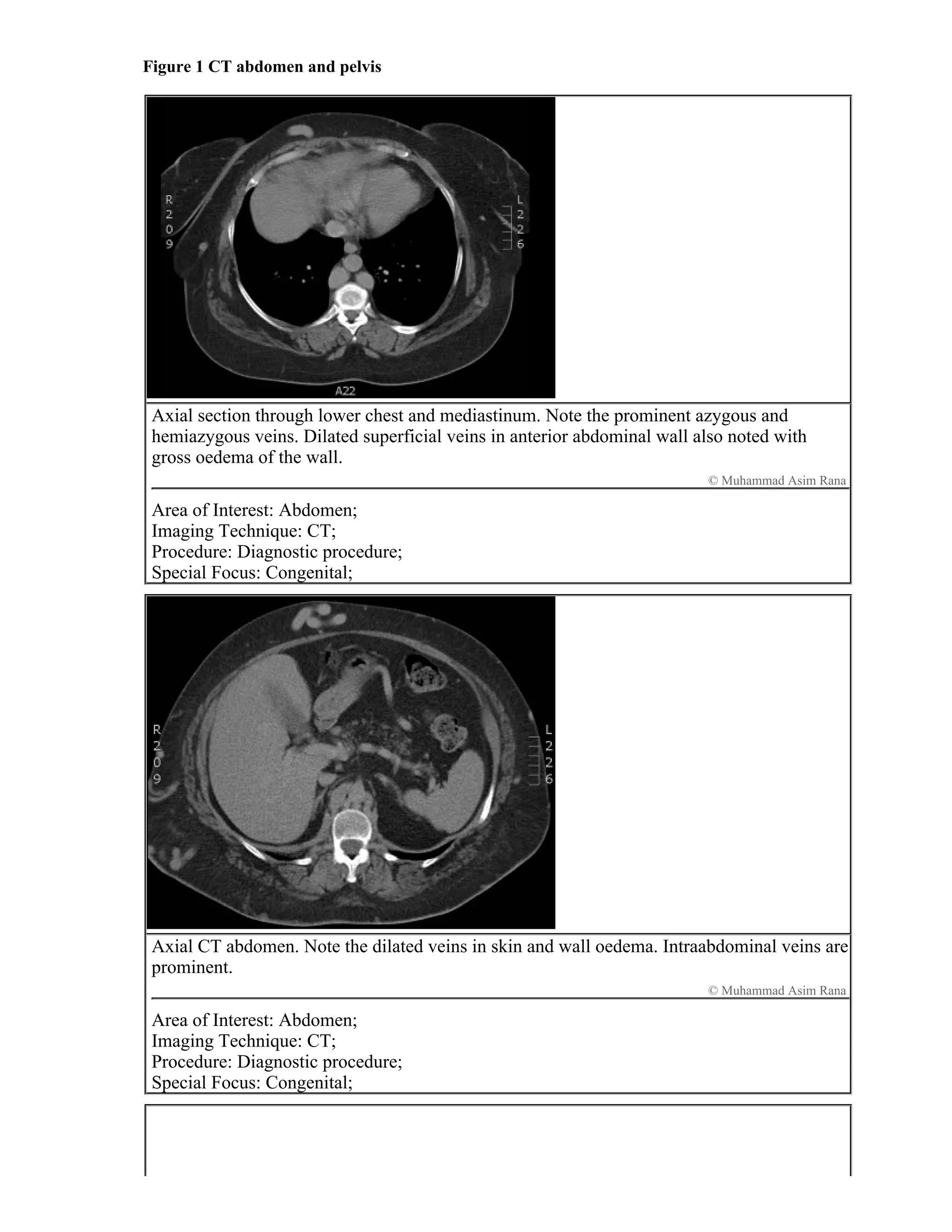 Congenitally absent Inferior Vena Cava: A rare cause of recurrent DVT ...