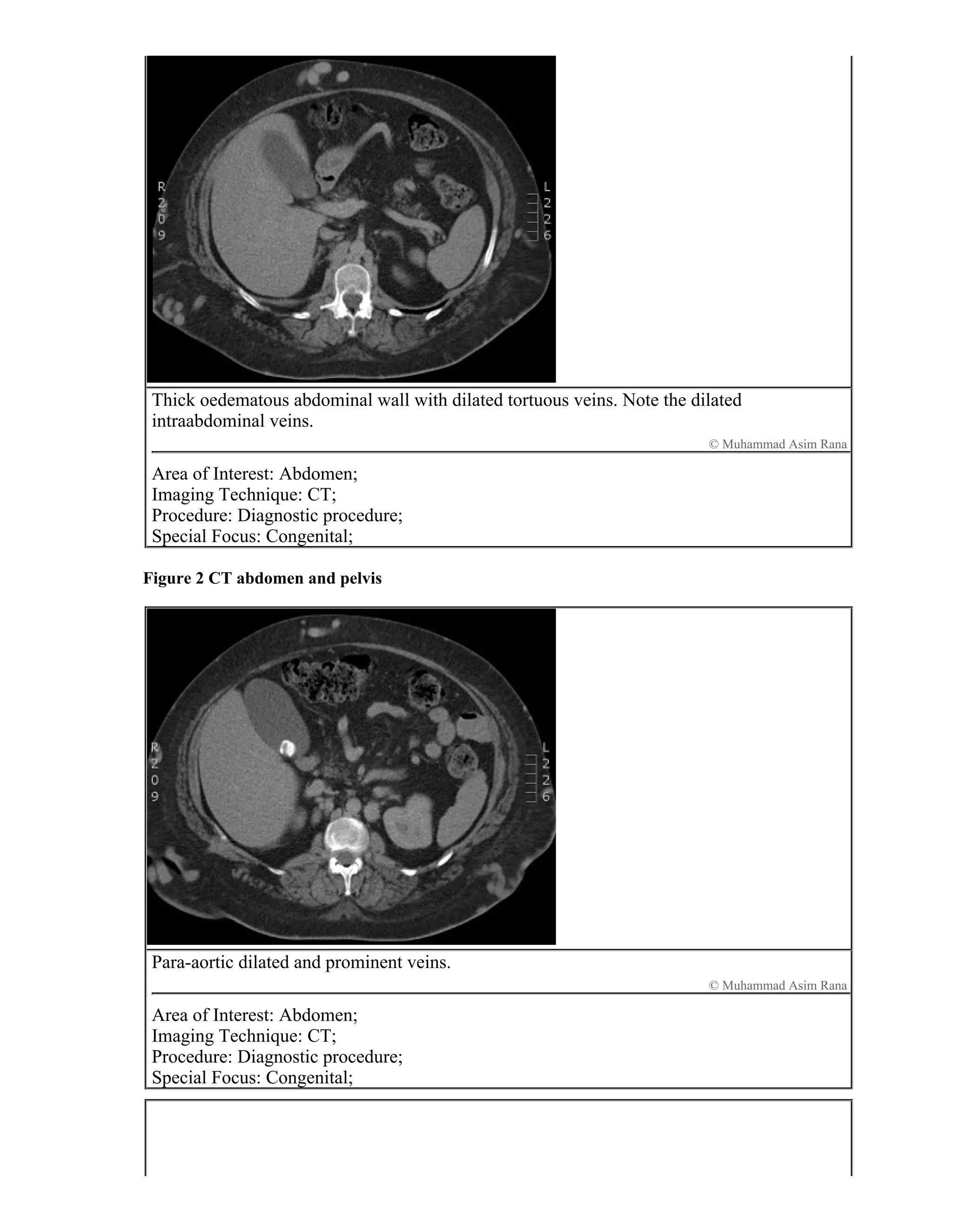 Congenitally absent Inferior Vena Cava: A rare cause of recurrent DVT ...