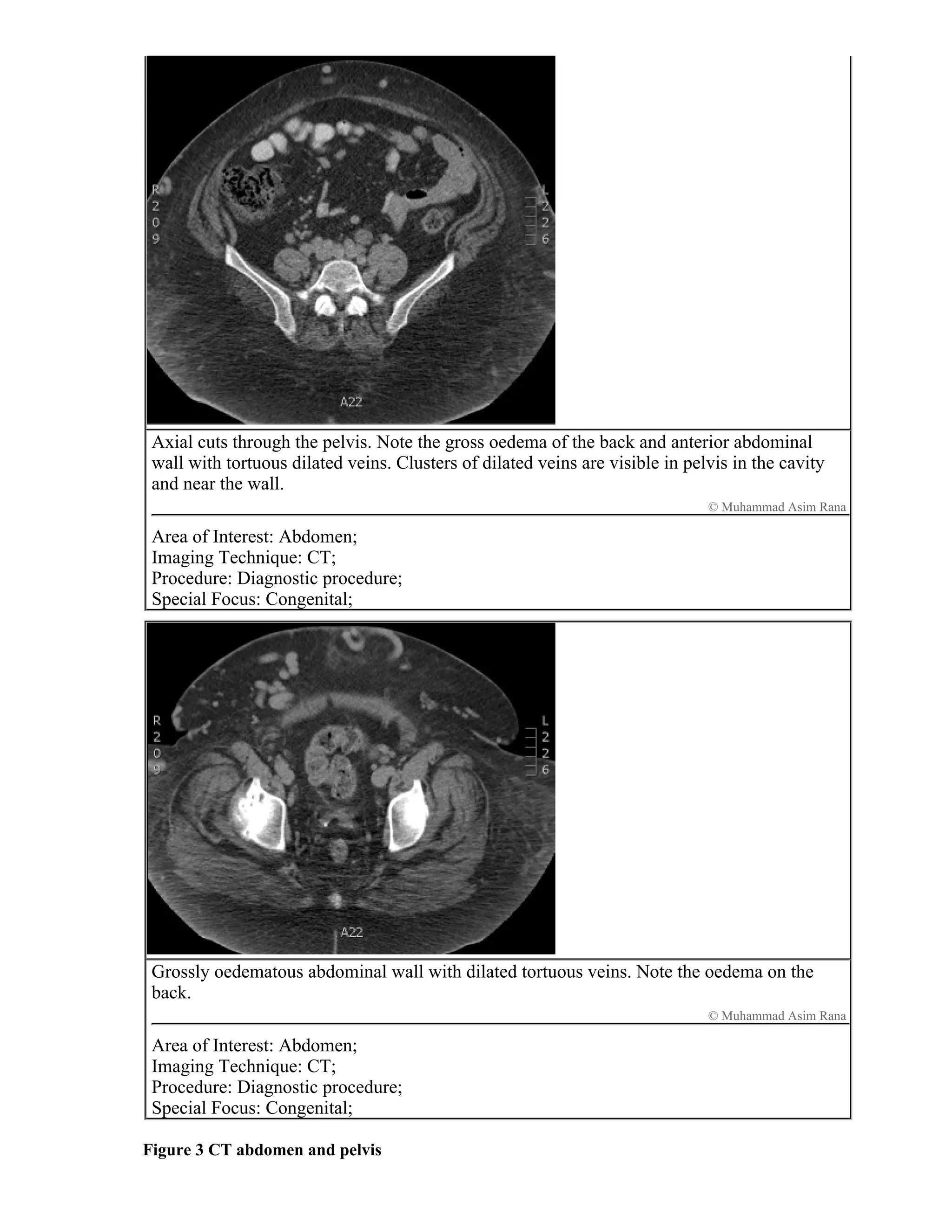 Congenitally absent Inferior Vena Cava: A rare cause of recurrent DVT ...