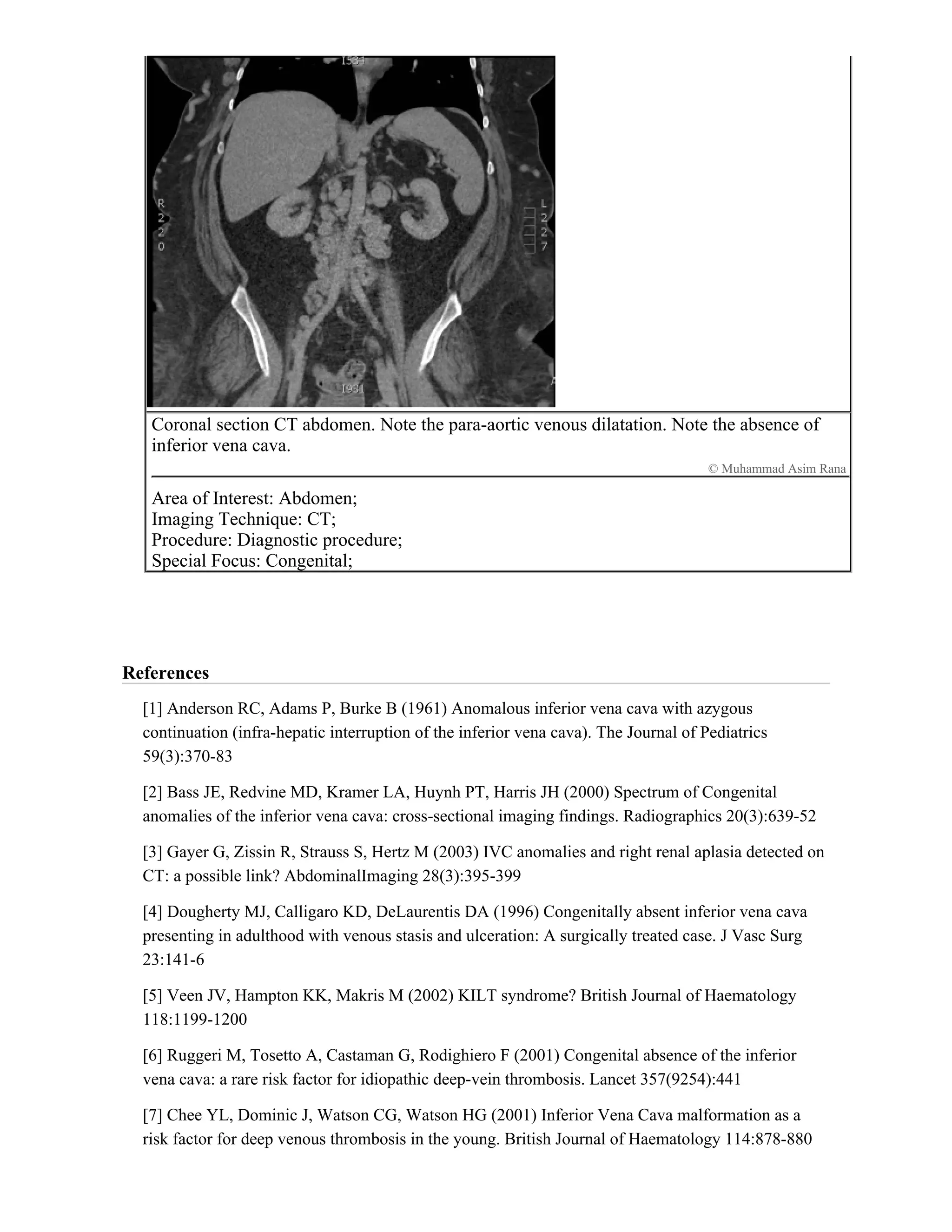 Congenitally absent Inferior Vena Cava: A rare cause of recurrent DVT ...