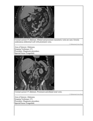 Congenitally absent Inferior Vena Cava: A rare cause of recurrent DVT ...
