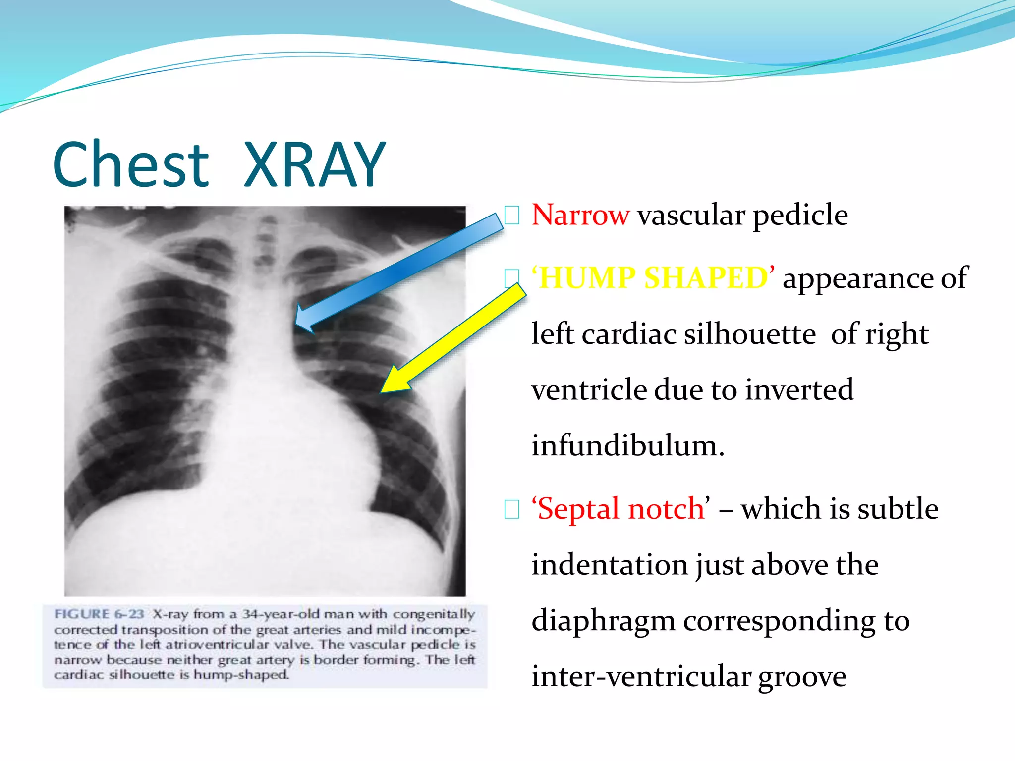 Congenitally corrected transposition of great arteries | PPTX