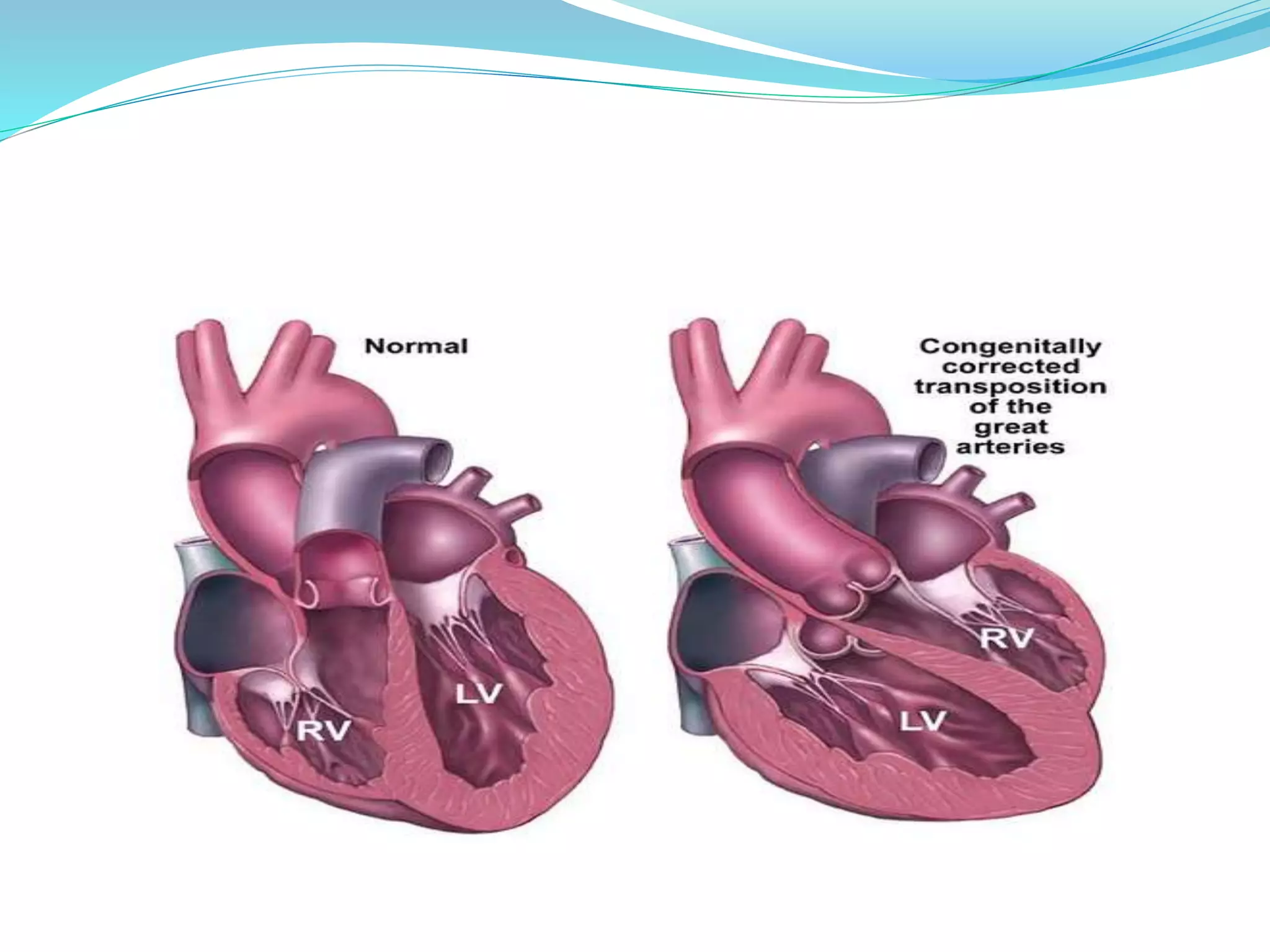 Congenitally corrected transposition of great arteries | PPTX