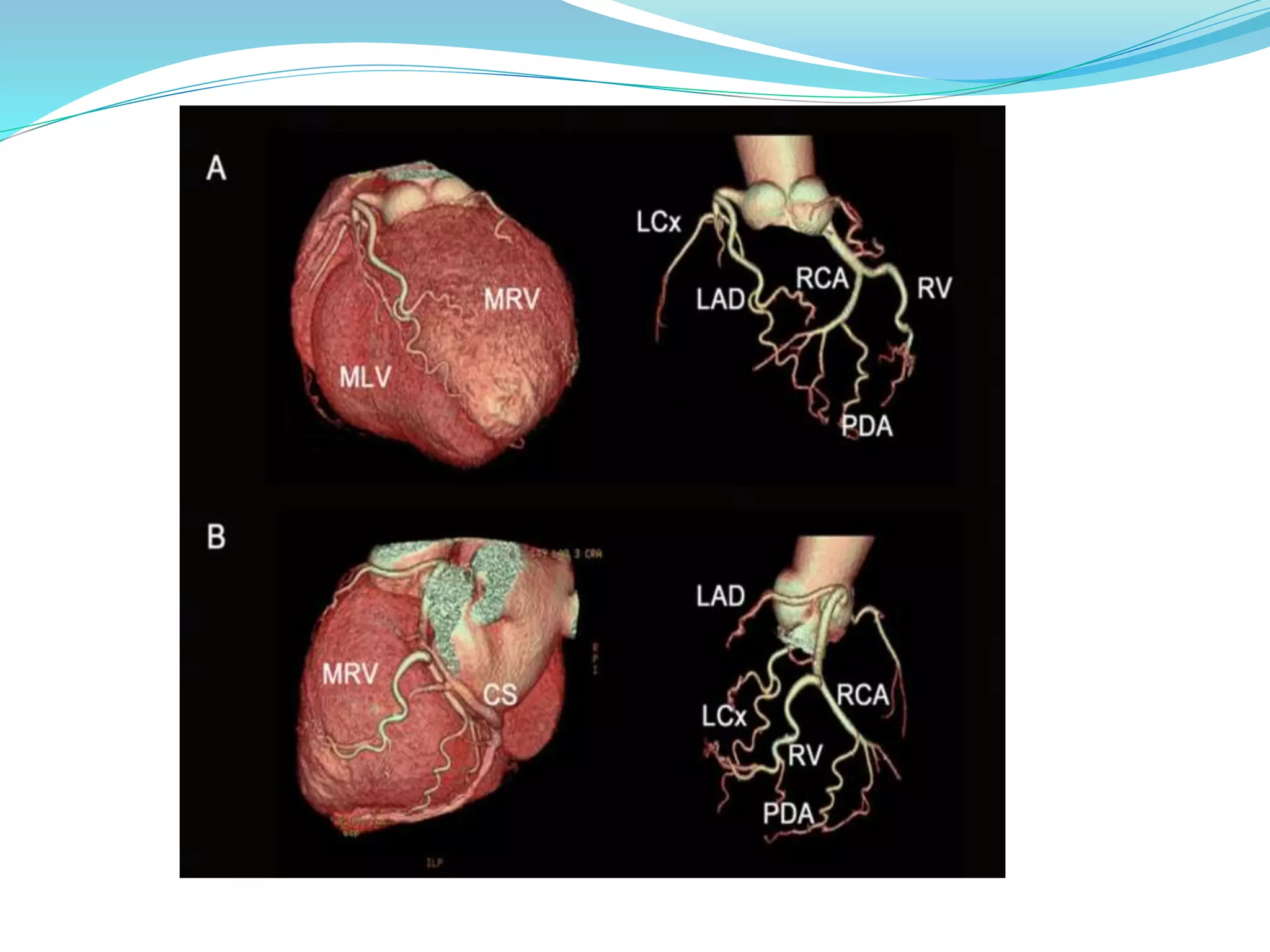 Congenitally corrected transposition of great arteries | PPTX
