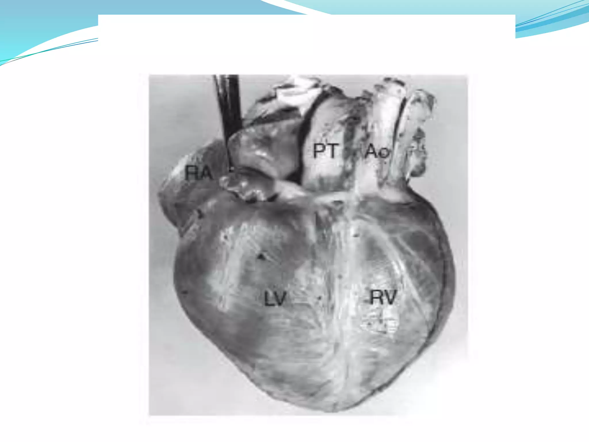 Congenitally corrected transposition of great arteries | PPTX