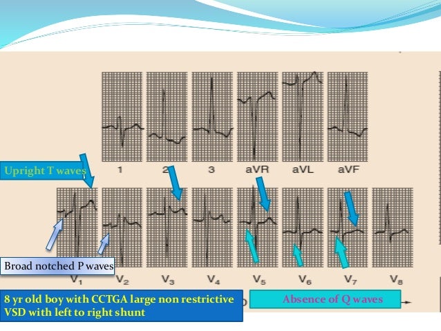 Congenitally corrected transposition of great arteries