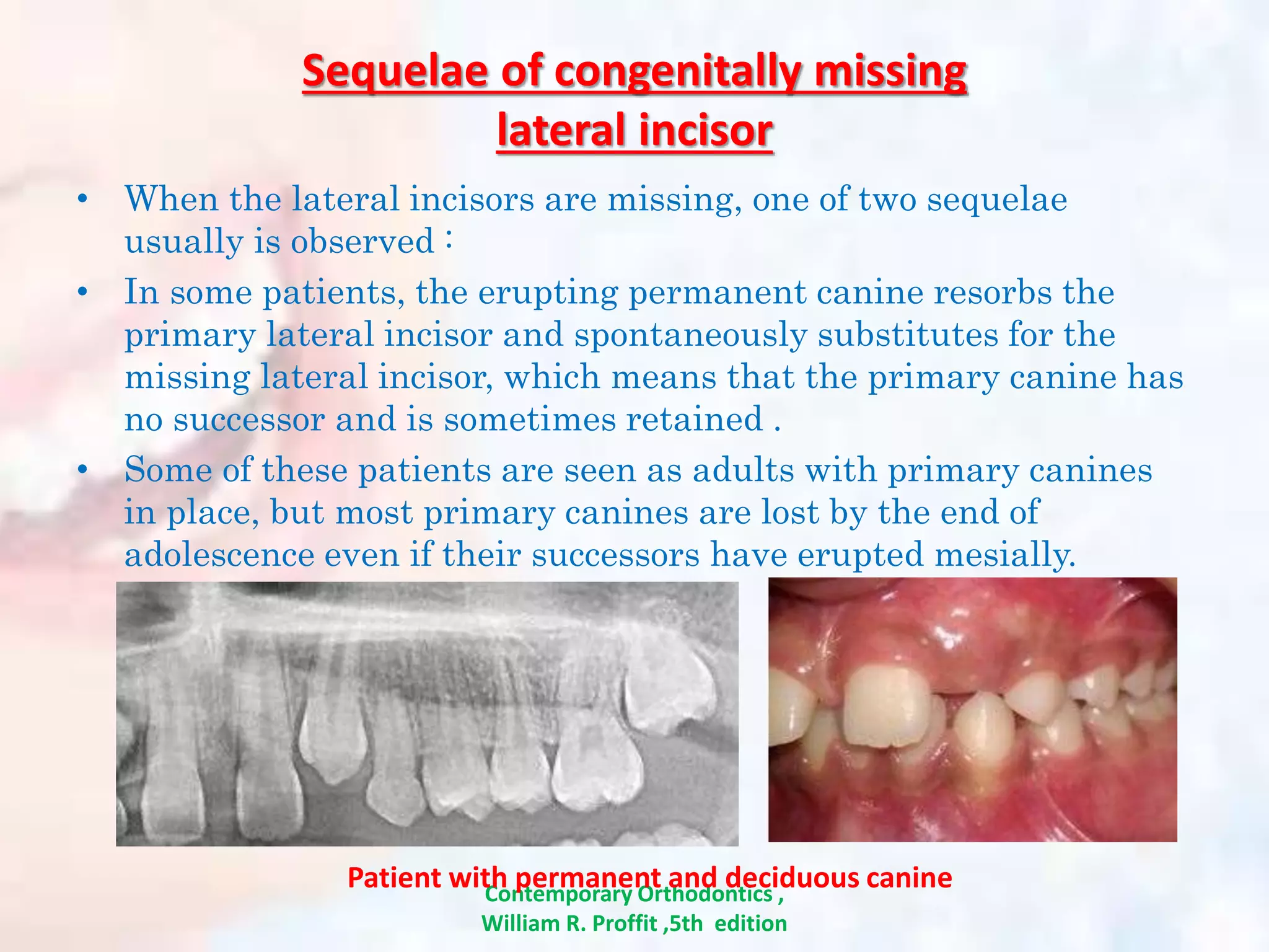 Congenitally Missing Maxillary Lateral Incisor | PPTX