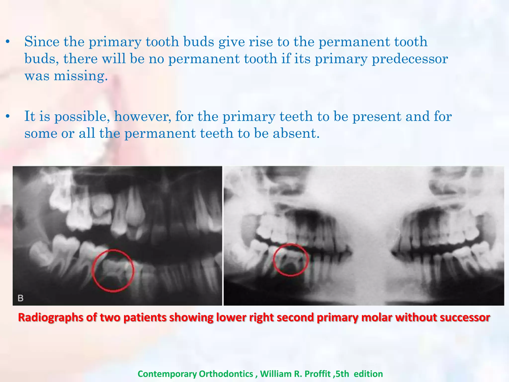 Congenitally Missing Maxillary Lateral Incisor | PPTX