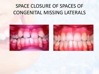 Congenitally Missing Maxillary Lateral Incisor | PPTX
