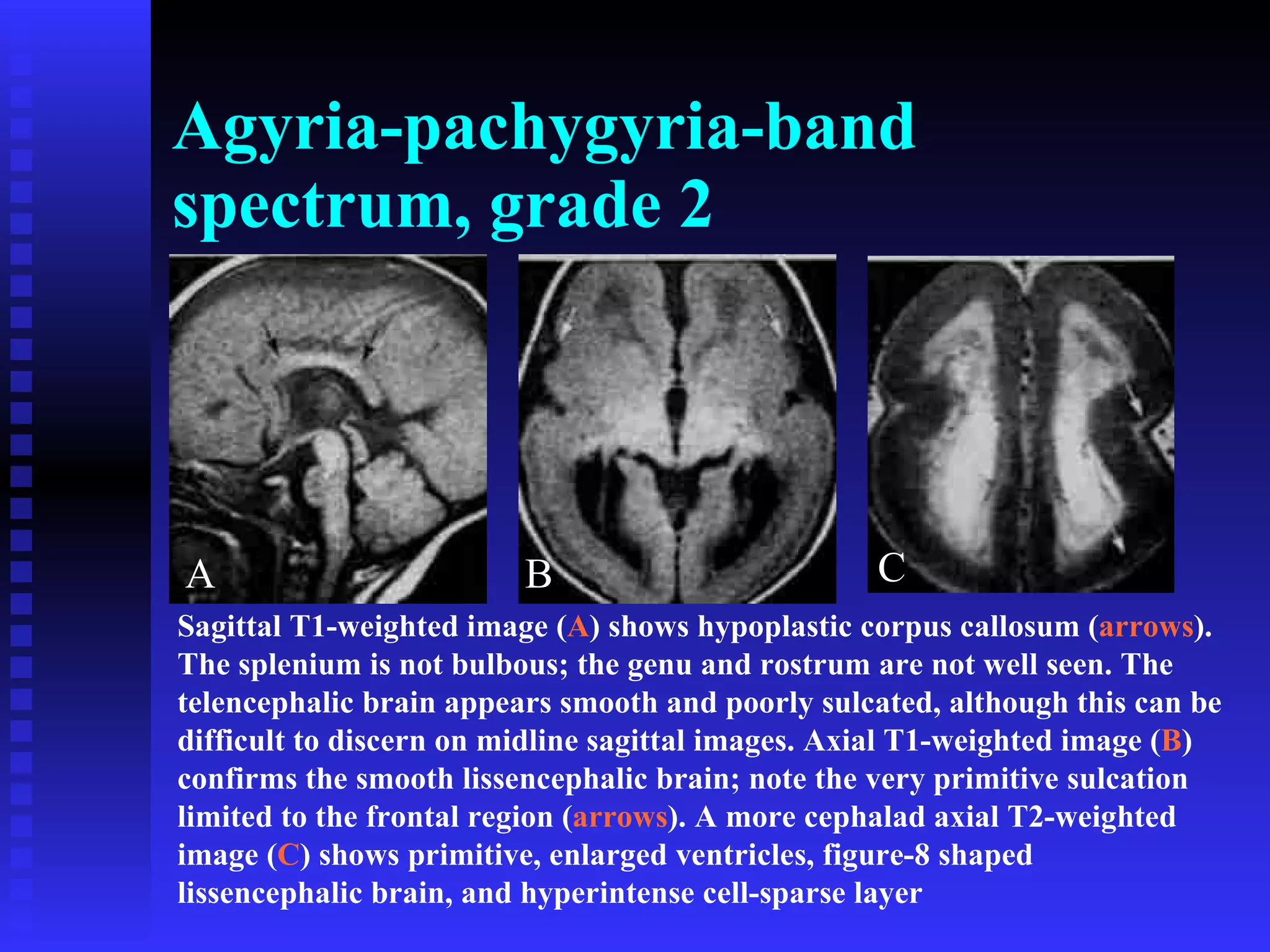Congenital malformation of cns | PPT