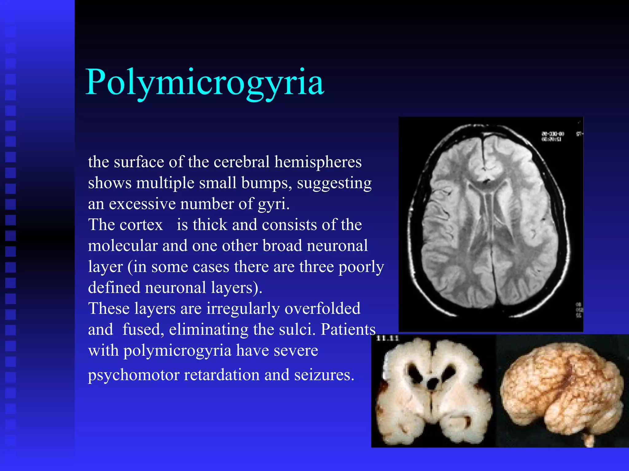 Congenital malformation of cns | PPT