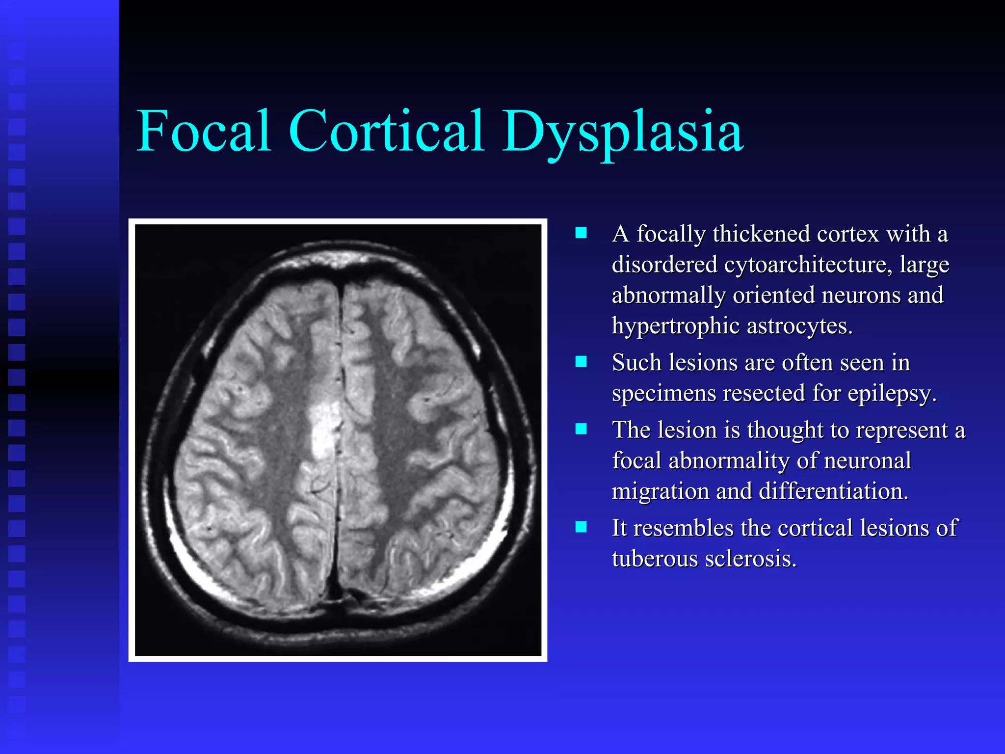Congenital malformation of cns | PPT
