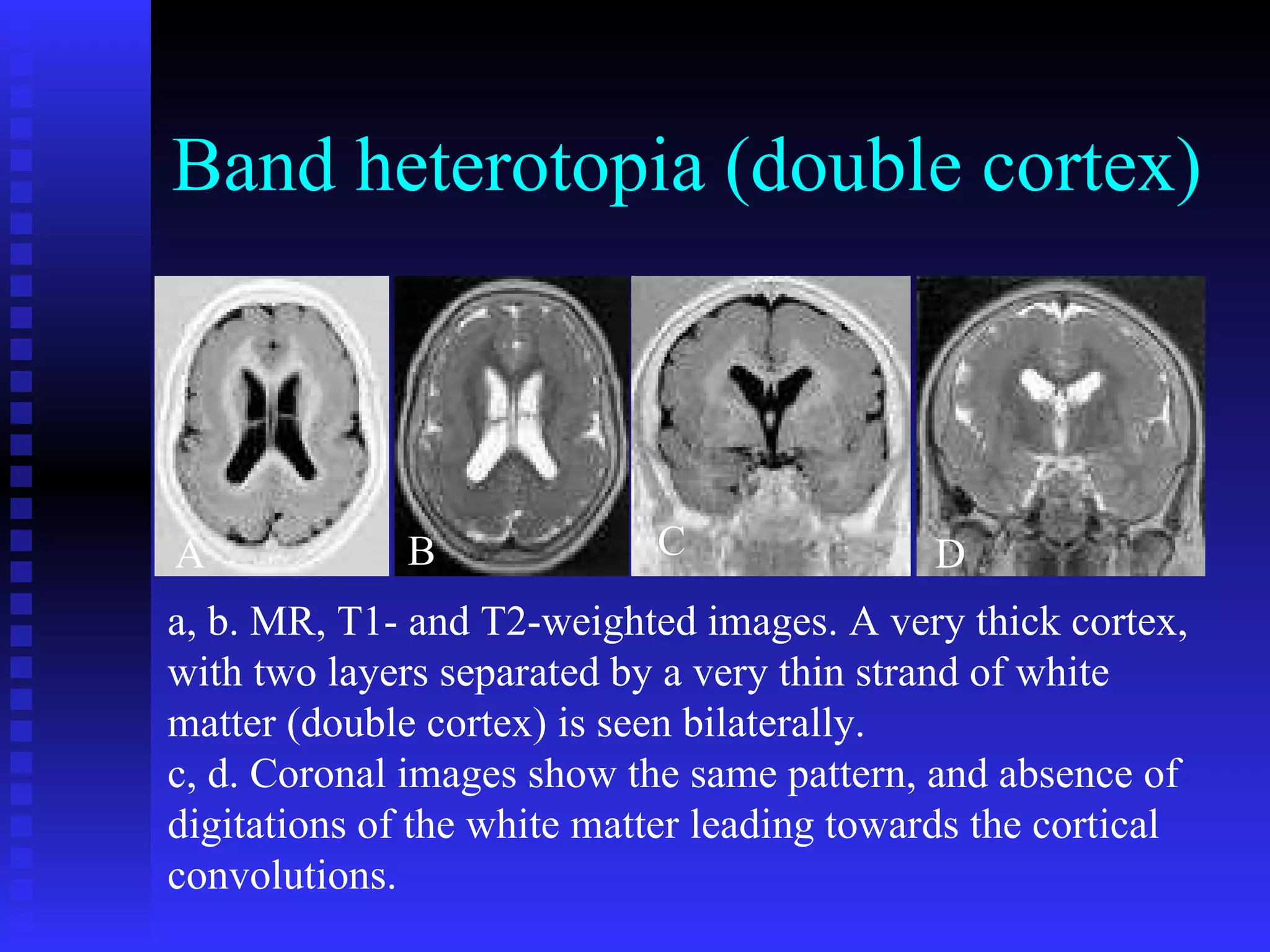 Congenital malformation of cns | PPT