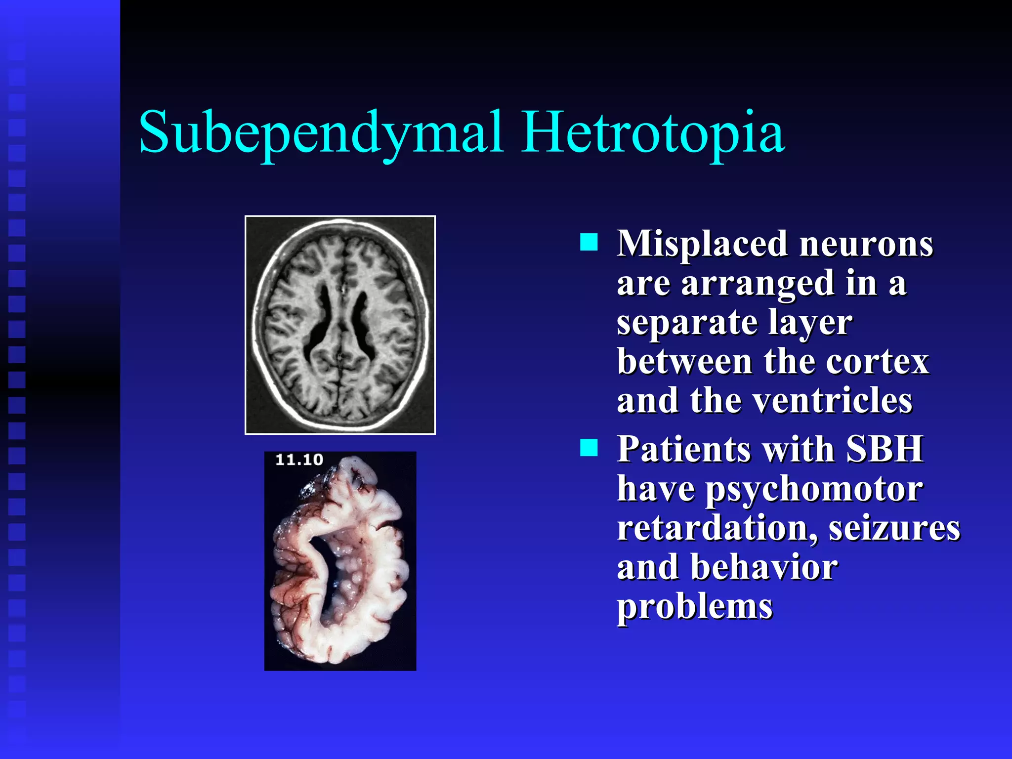 Congenital malformation of cns | PPT