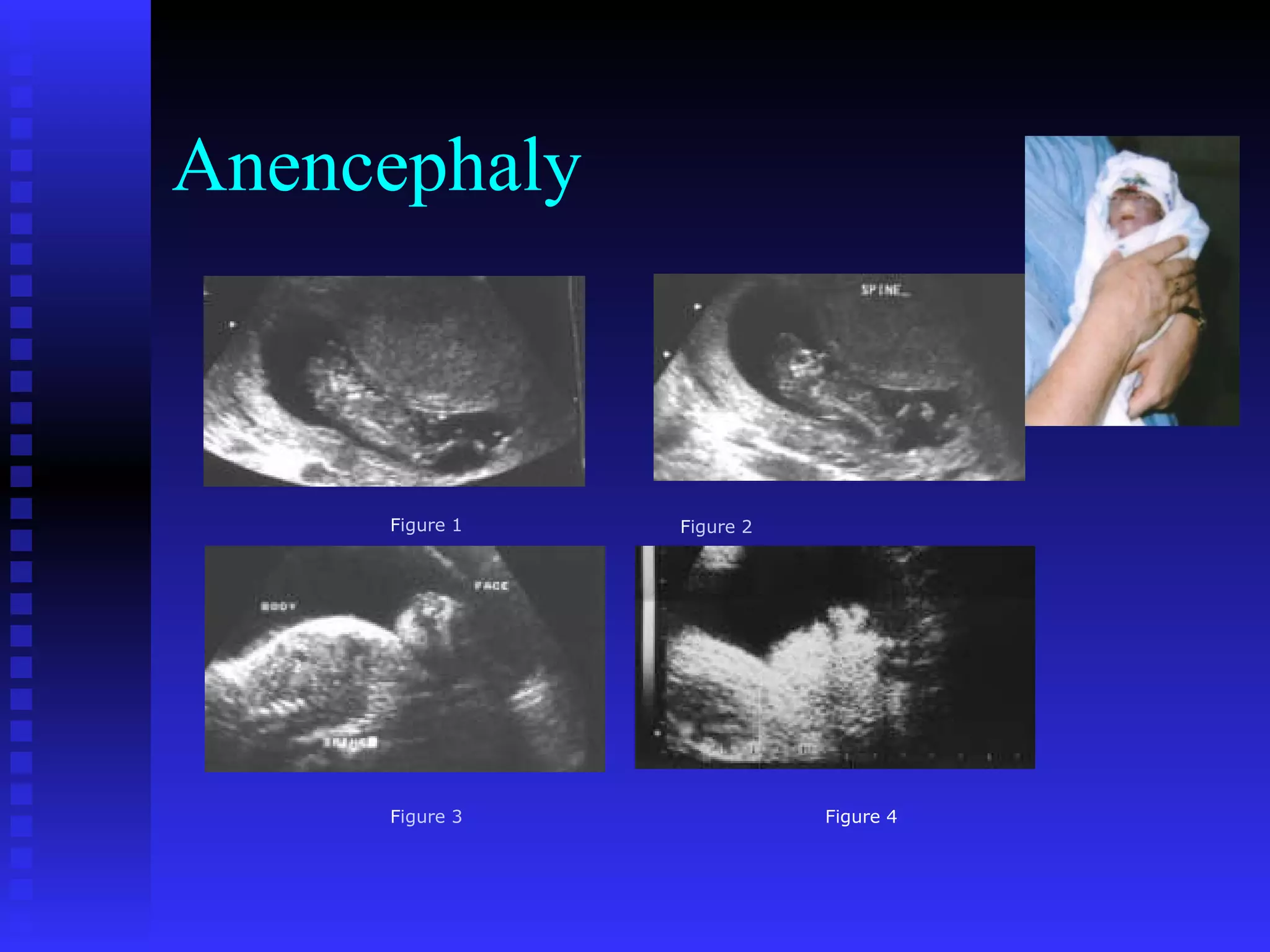 Congenital malformation of cns | PPT