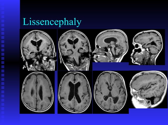 Congenital malformation of cns | PPT