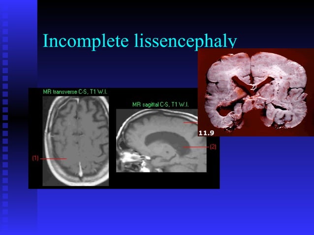 Congenital malformation of cns | PPT