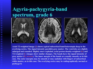 Congenital malformation of cns | PPT