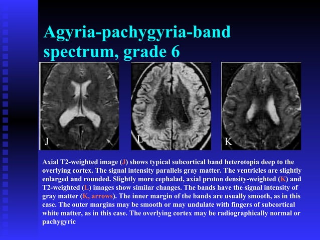 Congenital malformation of cns | PPT