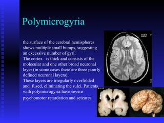 Congenital malformation of cns | PPT