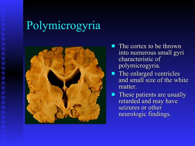 Congenital malformation of cns | PPT